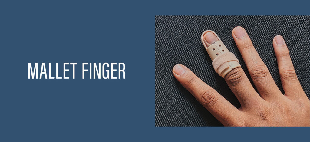 Mallet Finger: What Is It and How Is It Treated? | Hand Center of Louisiana