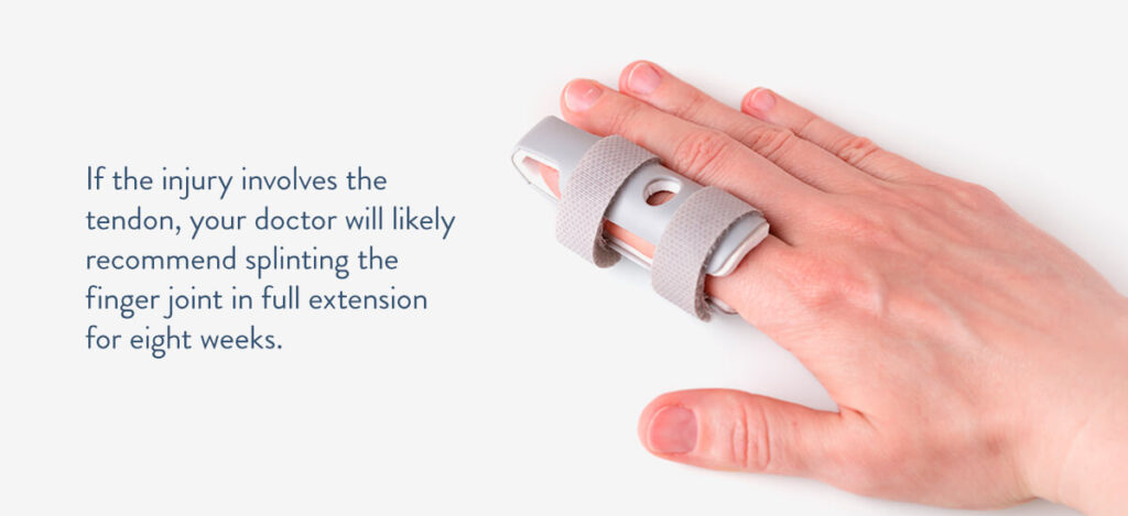 Mallet Finger: What Is It and How Is It Treated? | Hand Center of Louisiana