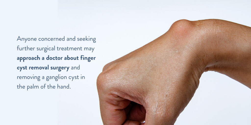 Ganglion Cyst Removal: Treatment Options | Hand Center